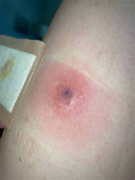 Staph Infection Mrsa Rdiagnoseme
