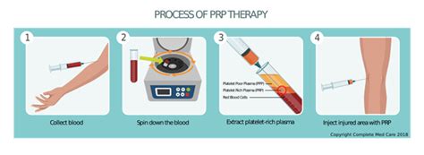 Prp Therapy Dallas — Complete Medcare By Complete Medcare Medium