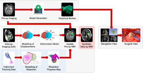 Workflow To Model Deformation And Compensate For Brain Shift Utilizing Download Scientific