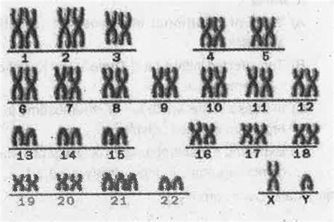 [malayalam Solution] Karyotype Of Human Chromosome Compliment Is Given