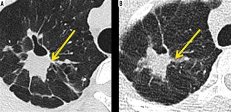 The Role Of Ultra Low Dose Computed Tomography In The Detection Of Pulmonary Pathologies A