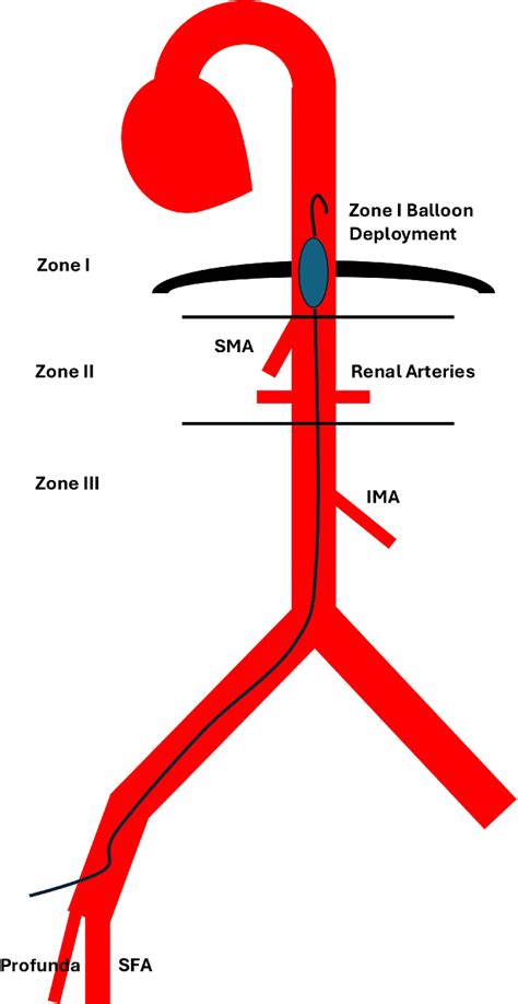 Figure 1 From Is Occlusion The Solution Reboa As A Hemorrhage Control