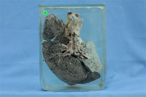 结核 88 9 急性粟粒性肺结核病理标本博物馆 复旦大学基础医学院