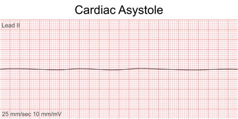 Acls Asystole And Pea Algorithm Diagnosis Causes And Management