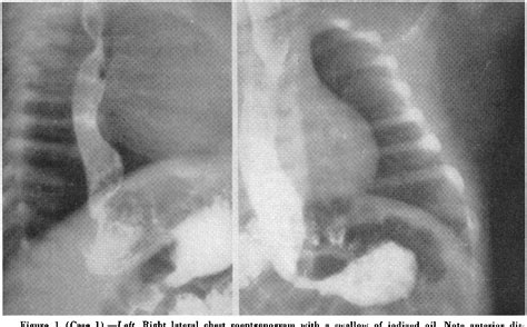 Figure 1 From Double Aortic Arch Semantic Scholar