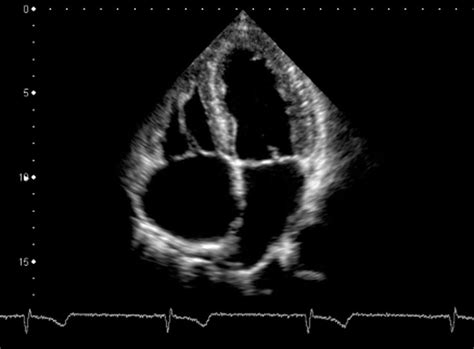 Use Of The Echocardiogram To Define The Presence Extent And Etiology Of Cardiac Dysfunction