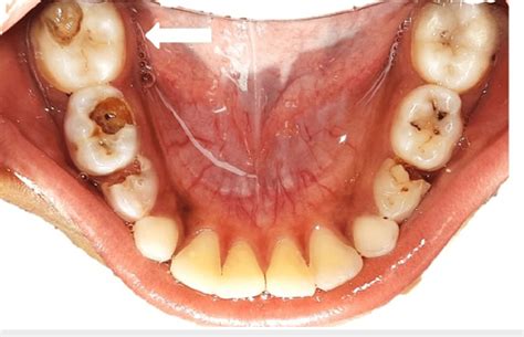 What Is Occlusal Caries At Jason Vincent Blog