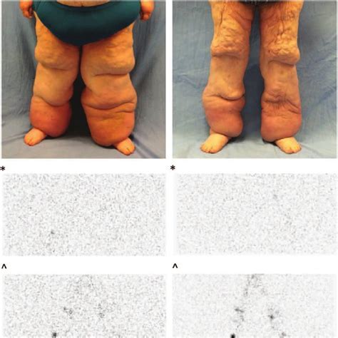 Pdf Obesity Induced Lymphedema Nonreversible Following Massive Weight