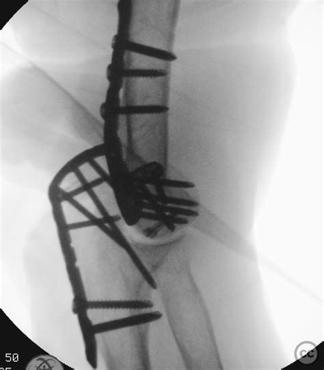 Transolecranon Dubberly 2b Fracture Dislocation