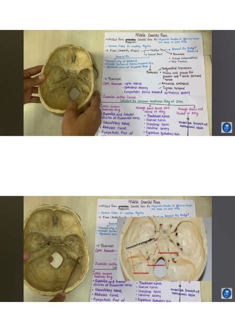 Middle Cranial Fossa Pdf