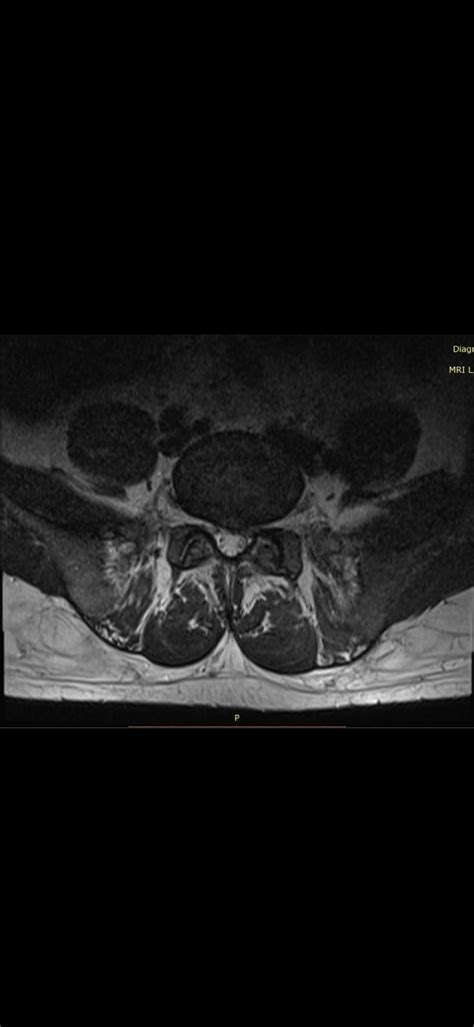 New Onset Sciatica While Walkingstanding Up Straight Really Dont
