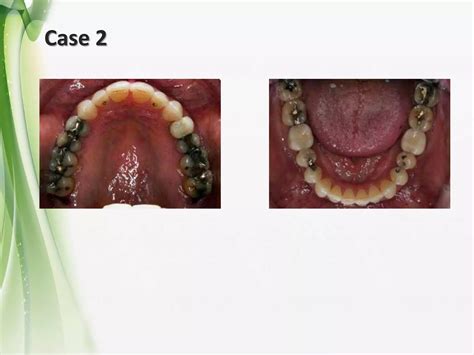 Intrusion And Extrusion Invisalign Ppt