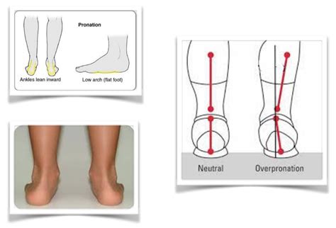 What Causes Pronation Of Foot High Arch Feet Pes Cavus Causes