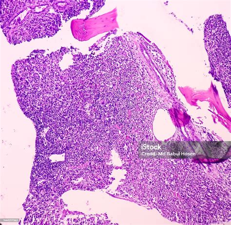 비호 지킨 림프종 현미경으로 과세포 세포 거핵구 비정형 림프구 세포 집단이있는 과립구를 보여줍니다 0명에 대한 스톡 사진 및