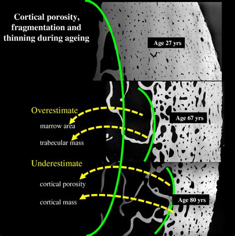 Increasing Cortical Porosity In Advanced Age Fragments The Inner Cortex
