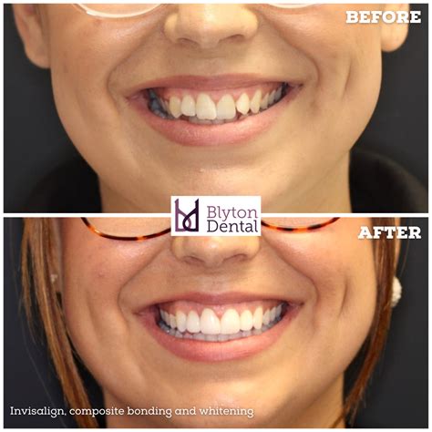 Invisalign Composite Bonding And Whitening — Blyton Dental