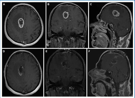 Figure 5 From Interhemispheric Transcingulate Sulcus Approach To Deep