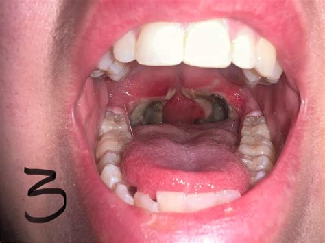 Tonsillectomy Recovery With Pictures R Tonsilstones