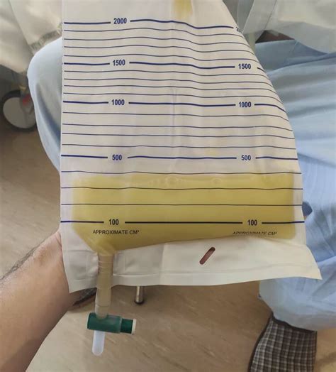 How To Empty An Abdominal Drain At Sophia Hoff Blog