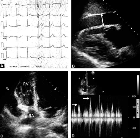 A Electrocardiogram Shows Sinus Rhythm With Diffuse St Elevation And Download Scientific