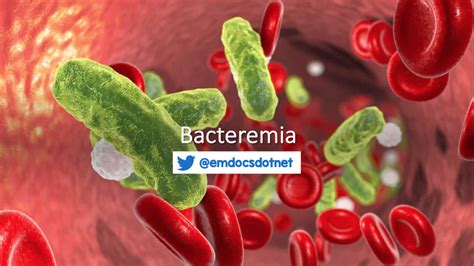 Bacteremia Ed Presentations Evaluation And Management Emdocs