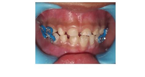 Conservative Management Of Mandibular Fracture With Maxillomandibular Fixation Using Orthodontic