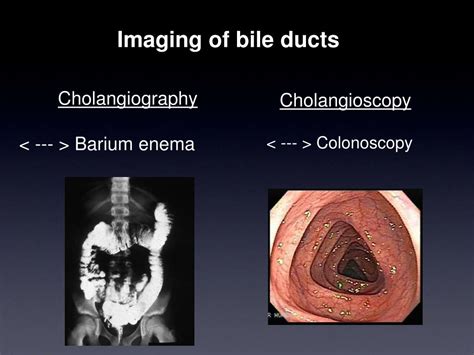 Ppt Cholangioscopy Powerpoint Presentation Free Download Id3430087
