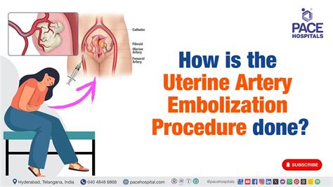 How Is The Uterine Artery Embolization Procedure Done Uterinearteryembolization Youtube