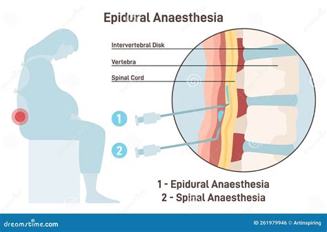 Epidural And Spinal Anesthesia Labor Anesthesia Of Pregnant Woman