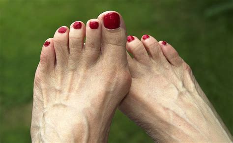 How To Treat Overlapping Toes Thomas A Mcdonald Md Faaos