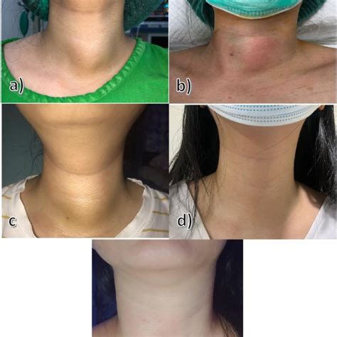 A 35 Years Old Women With Thyroid Nodule Since 6 Months Ago B Download Scientific Diagram