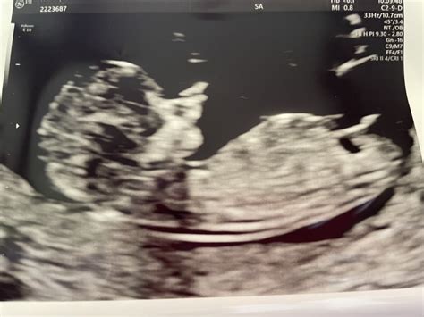 Sex Week Scan Mumsnet