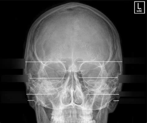 Frontal Sinuses Diagram Quizlet