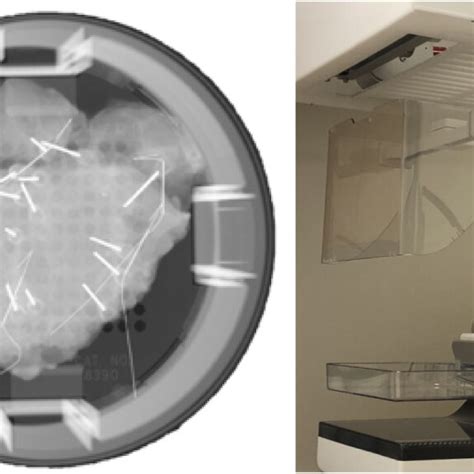 Pdf Visualizing Microcalcifications In Lumpectomy Specimens An Exploration Into The Clinical