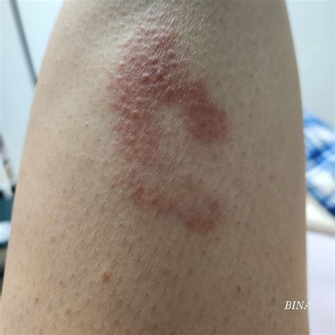 피부 붉은반점 지식in