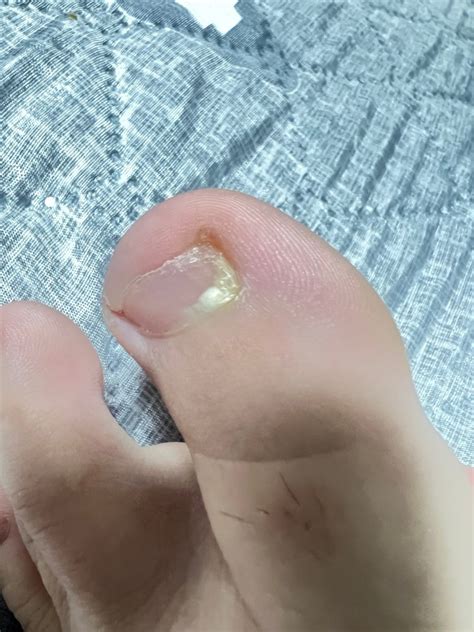 혹시 발톱 무좀 증상일까요 지식in