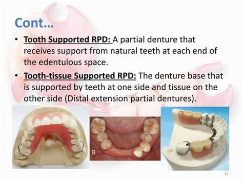 01 Introduction And Classification Partial Denture Pptx Dental Health Diseases And Conditions
