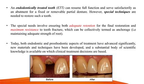 Rehabilitation Of Endodontically Treated Teeth Post And Core Pptx