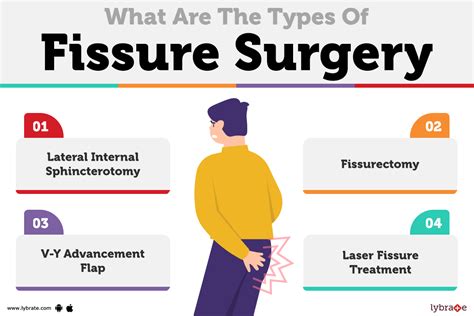 Fissure Surgery Purpose Procedure Benefits And Side Effects