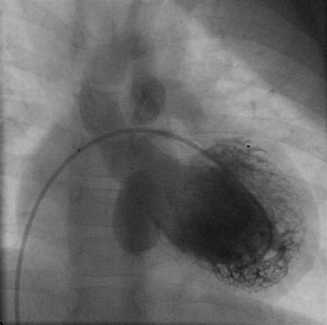 Angiographic Evidence Of Extensive Left Ventricular Noncompaction Note Download Scientific