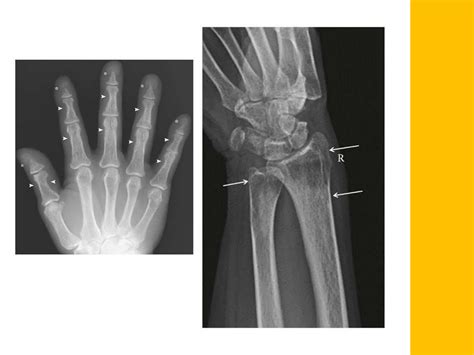 Hyperparathyroidism Pptx Bone And Joint Conditions Diseases And