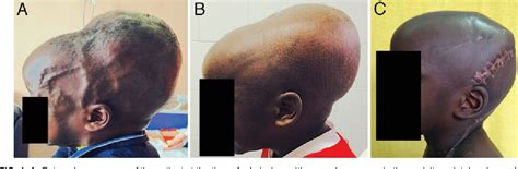Figure 4 From Giant Melanotic Neuroectodermal Tumor Of Infancy
