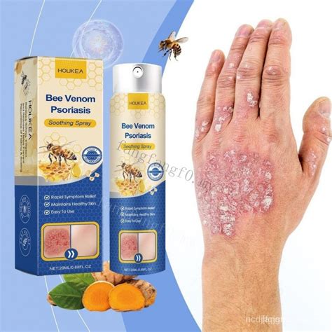 Jualan Hot Bee Venom Psoriasis Rawatan Spray Penjagaan Kulit Spray