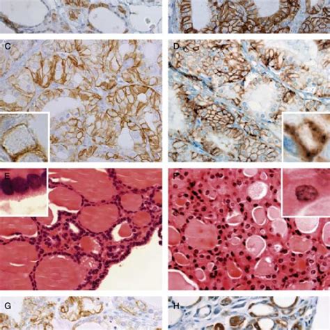Immunohistochemical Analysis Of Nis Expression And Localization In