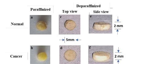 Breast Biopsy Tissue A Normal Paraffinized Tissue B Cancerous Download Scientific Diagram