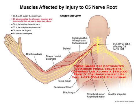 Muscles Affected By Injury To C5 Nerve Root