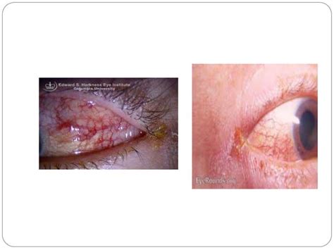 Angular Conjunctivitis Pptx Eye And Vision Conditions Diseases And Conditions