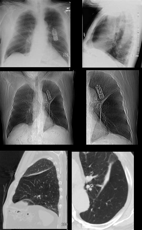 Atelectasis Lobes And Segments Lungs Atelectasis Lobes And Segments Lungs