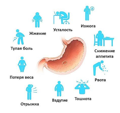 Как вылечить язву 12 перстной кишки Гастроэнтерология проктология Статьи Поиск Лекарств
