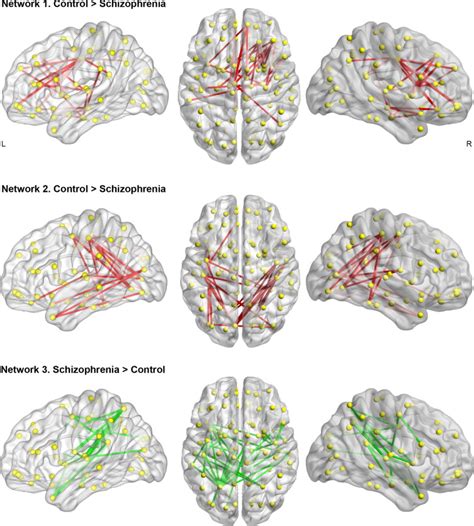 Patients With Schizophrenia Showed Decreased Functional Connectivity In Download Scientific